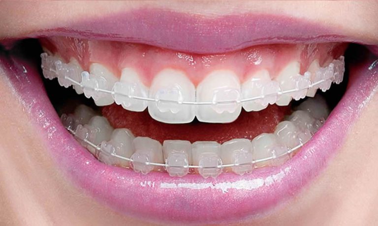 Ortodontia - Só Sorriso Odontologia | Recreio do Bandeirantes | Freguesia
